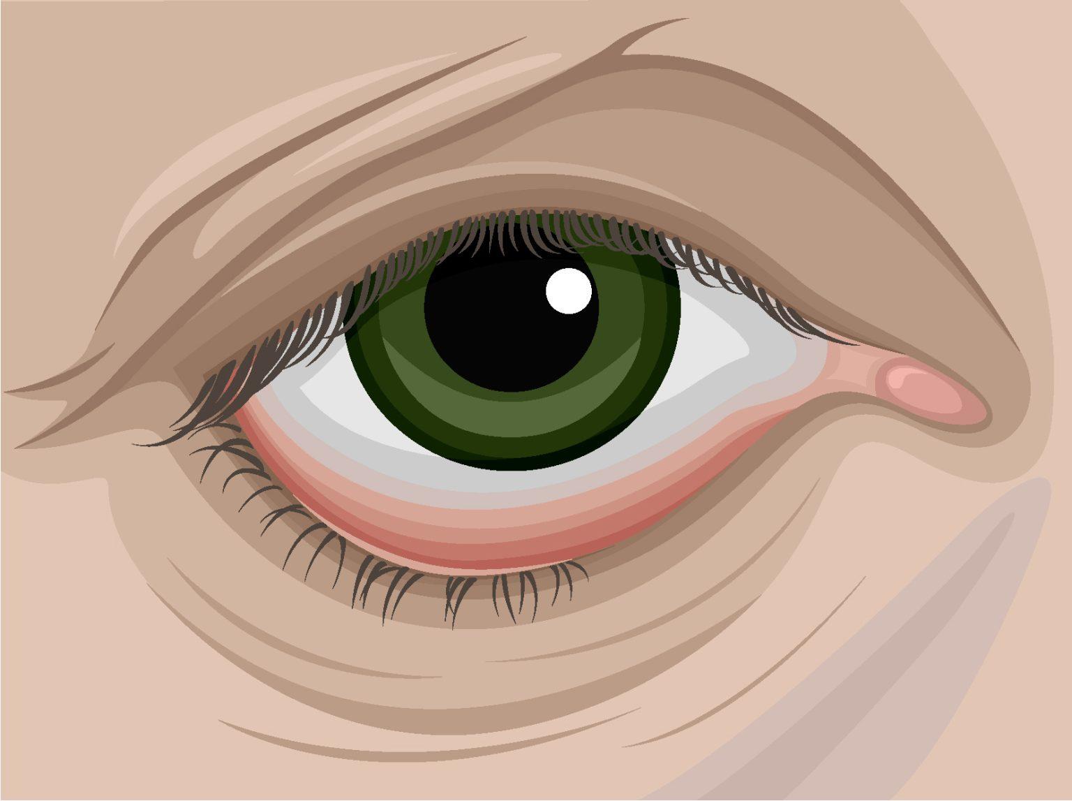 Ectropion Entropion | Eyes, Lids & Face Clinic