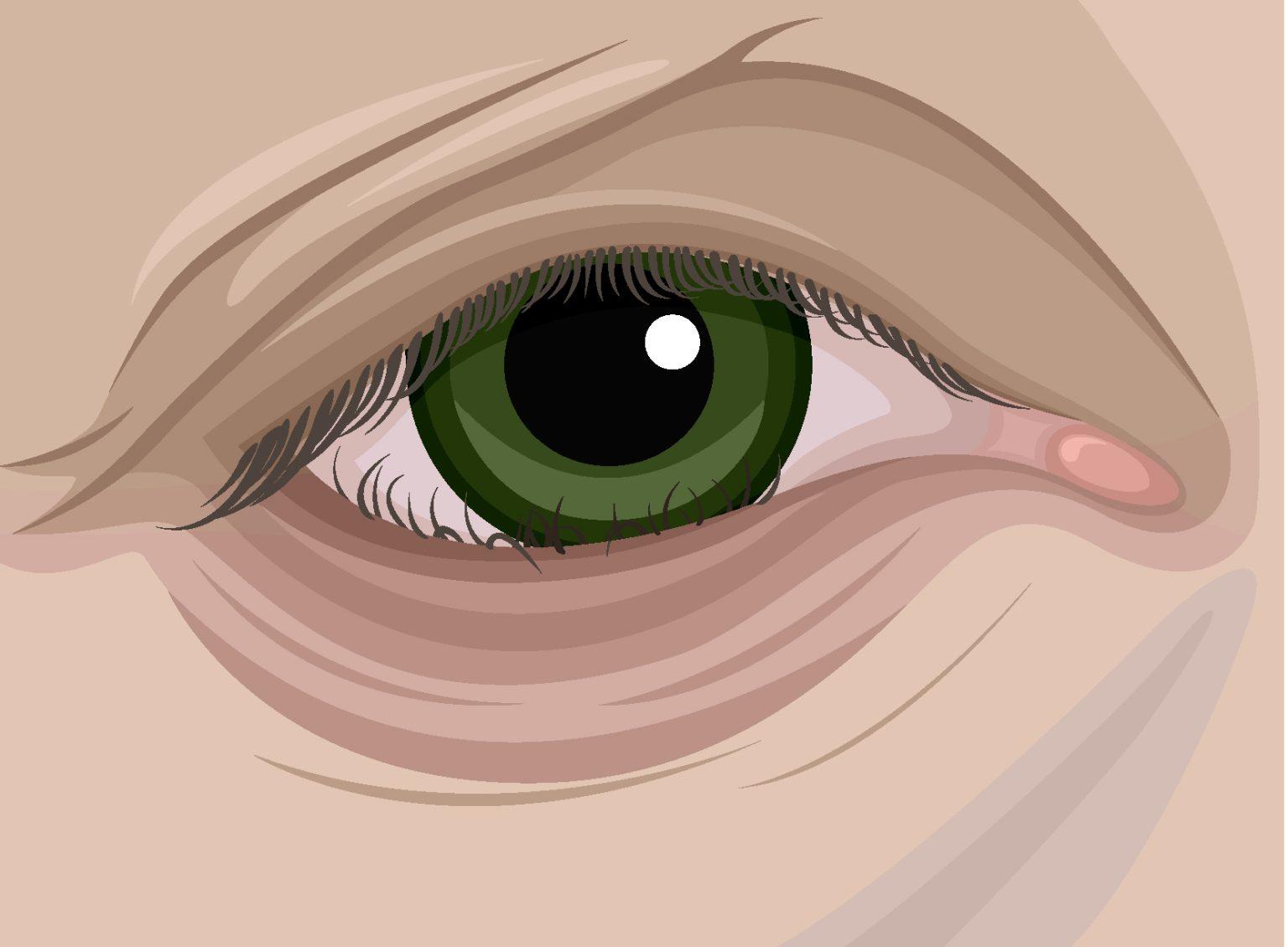 Ectropion Entropion | Eyes, Lids & Face Clinic