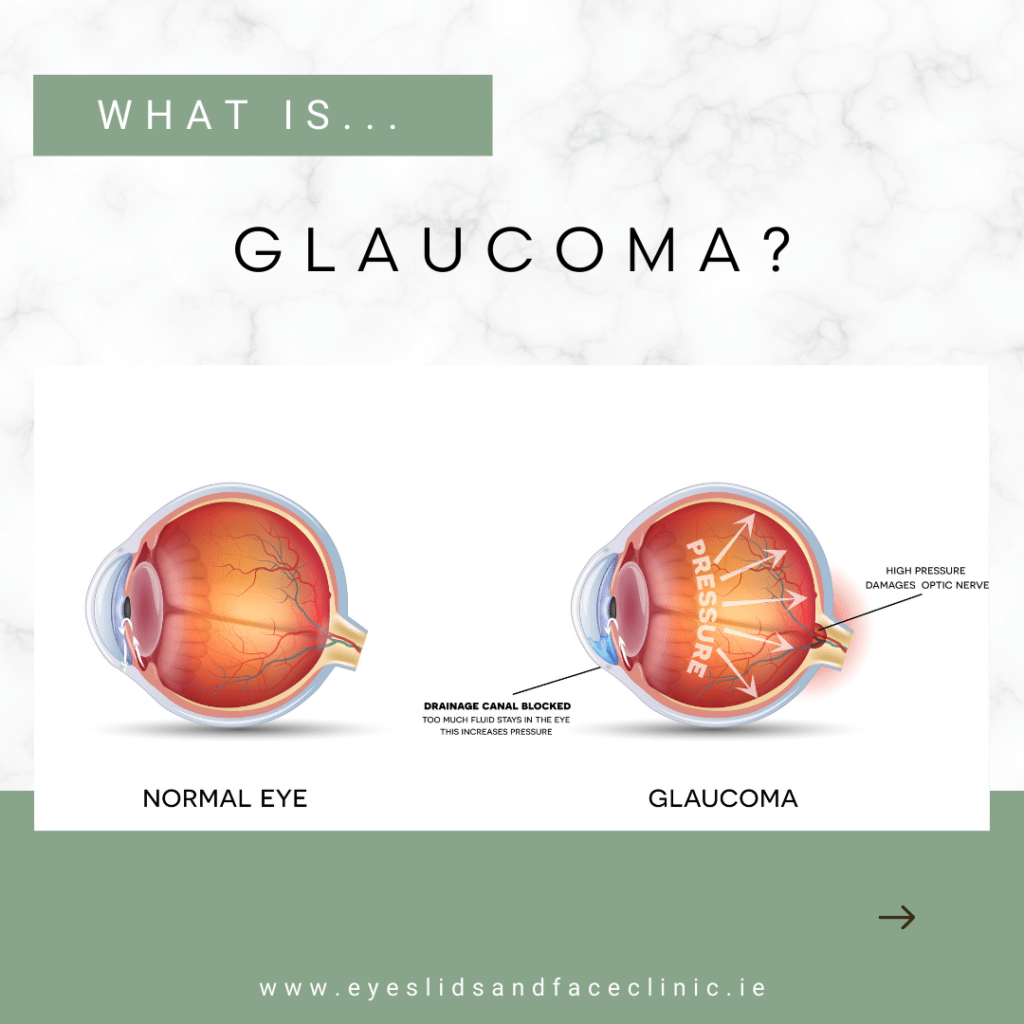 Understanding Glaucoma | Eyes, Lids & Face Clinic