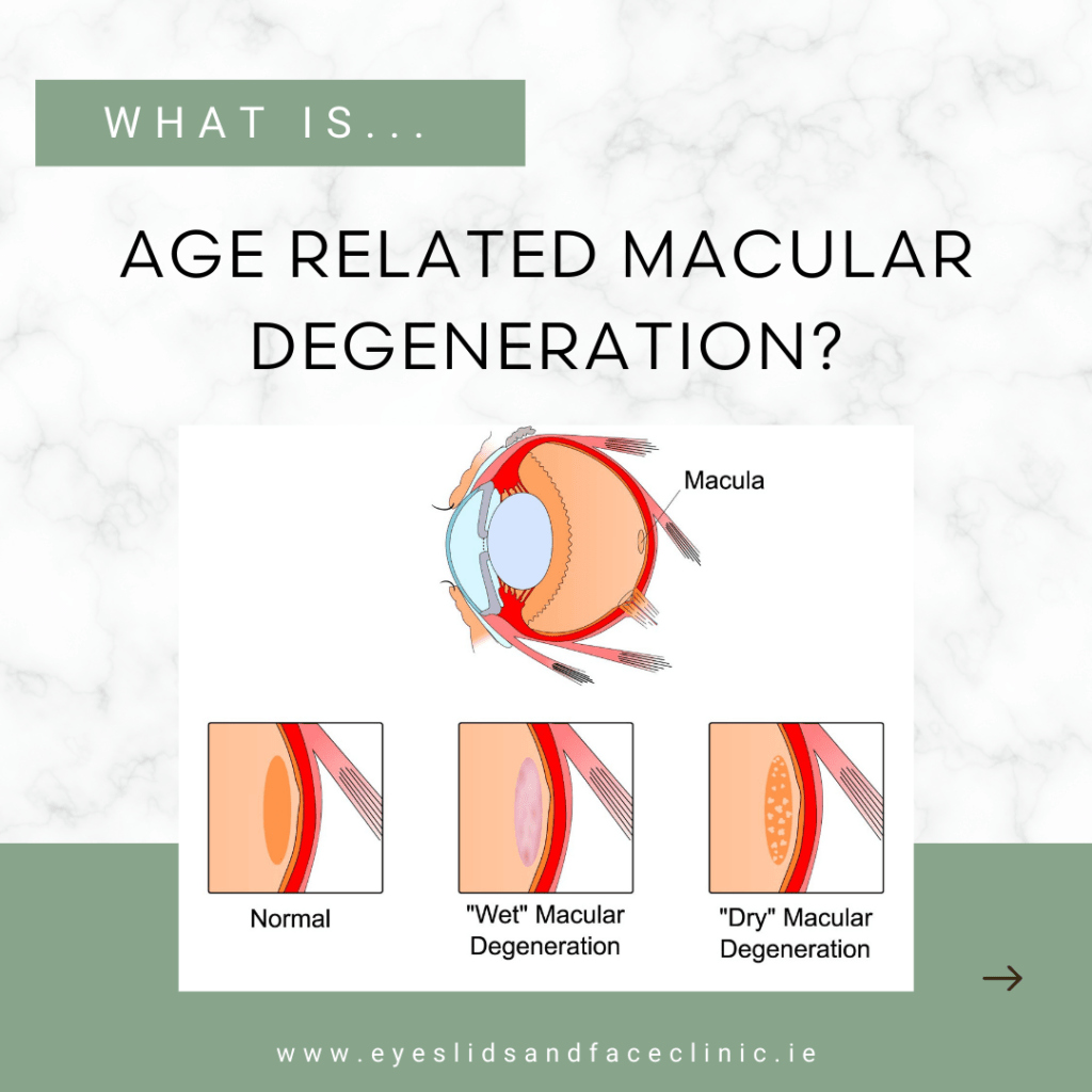 Age Related Macular Degeneration | Eyes, Lids & Face Clinic
