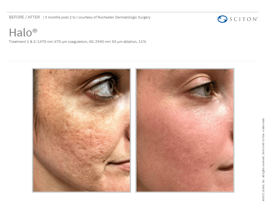 Sciton Halo Laser Treatment | Eyes, Lids & Face Clinic