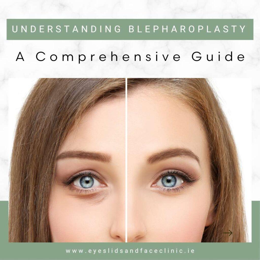 Understanding Blepharoplasty: A Comprehensive Guide