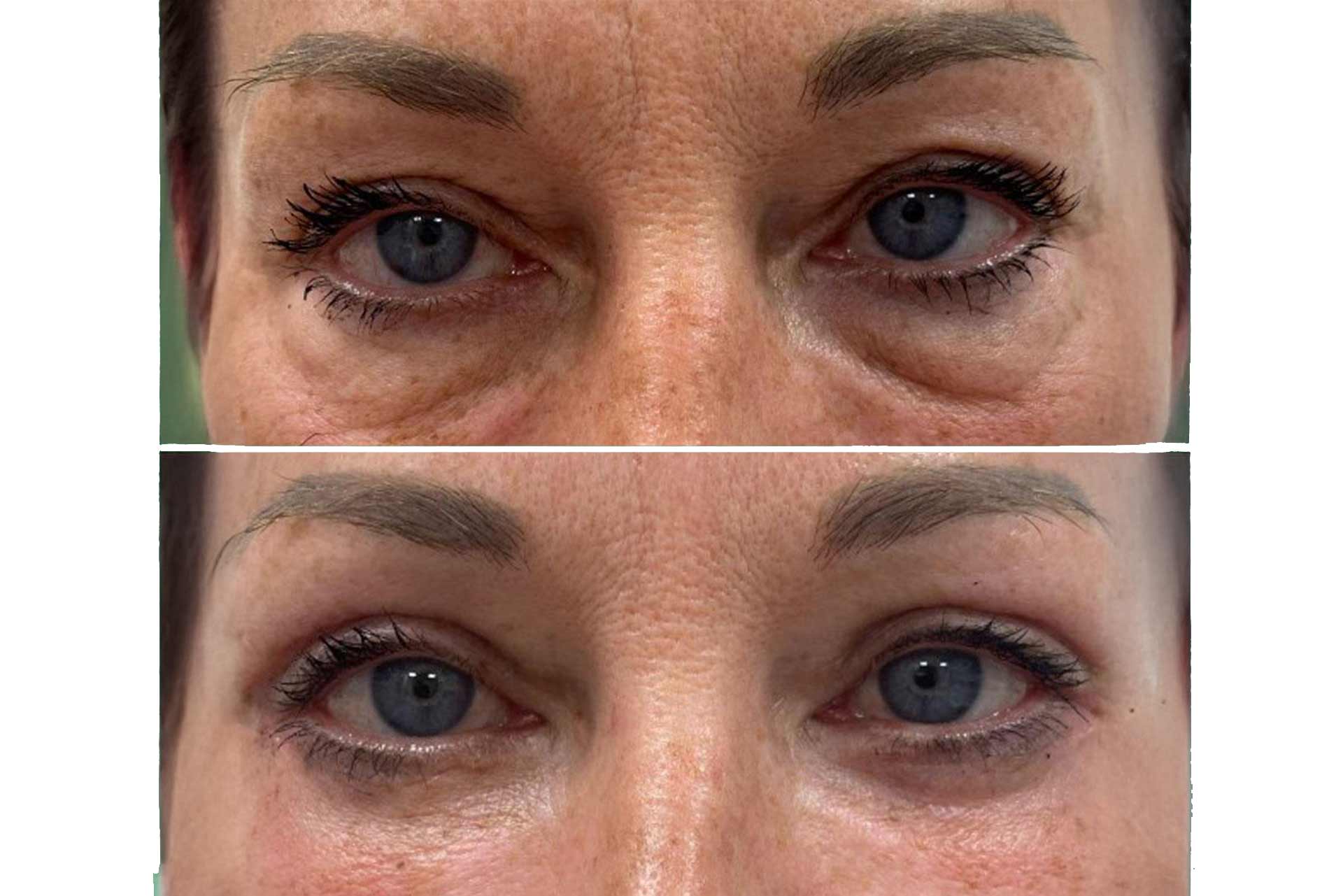 Before After Photos | Eyes, Lids & Face Clinic | Our Work